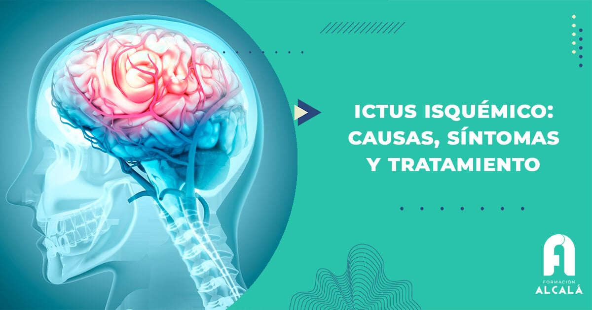 Ictus Isquémico| Formación Alcalá